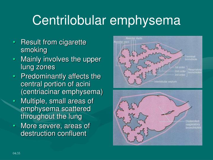 PPT - Imaging pattern of respiratory disease PowerPoint Presentation ...