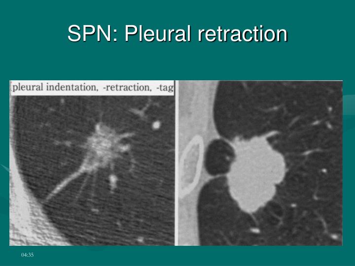 PPT - Imaging pattern of respiratory disease PowerPoint Presentation ...