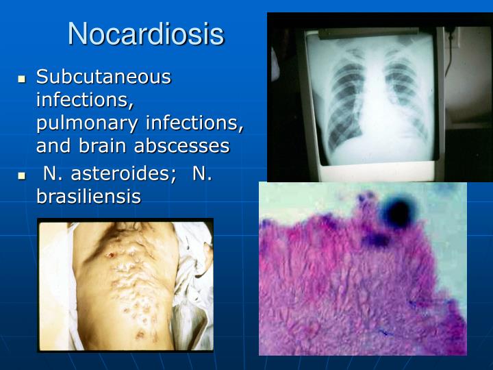 PPT - Actinomyces & Nocardia PowerPoint Presentation - ID:464498