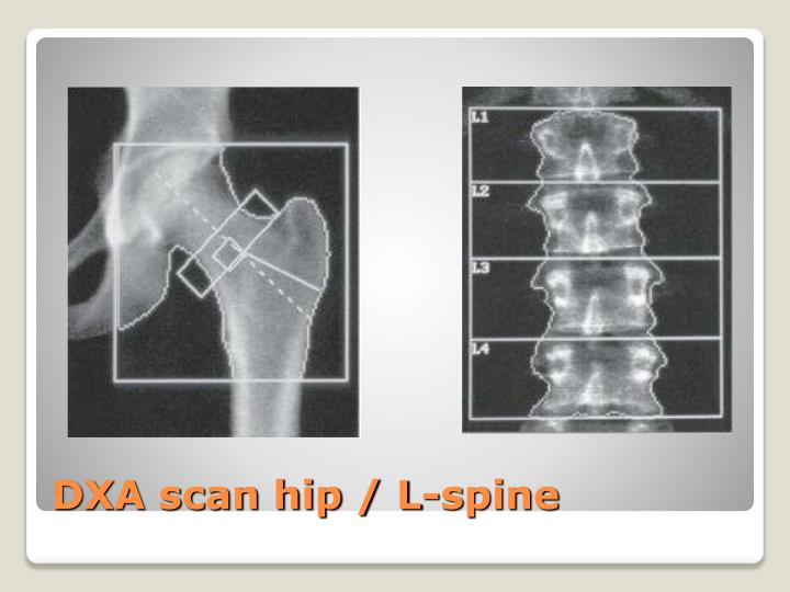PPT - Osteoporosis PowerPoint Presentation - ID:466557