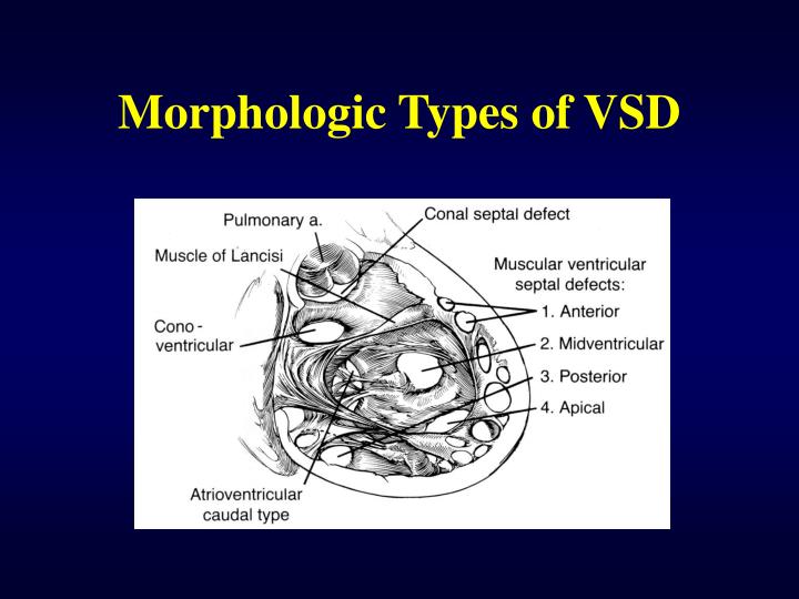 PPT - Ventricular Septal Defect PowerPoint Presentation - ID:468160
