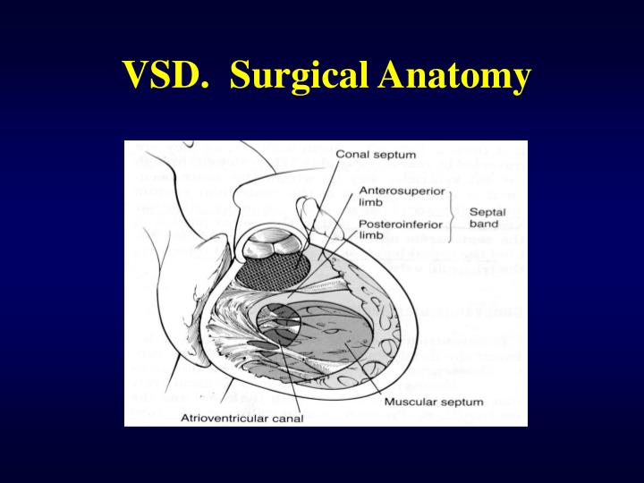 PPT - Ventricular Septal Defect PowerPoint Presentation - ID:468160