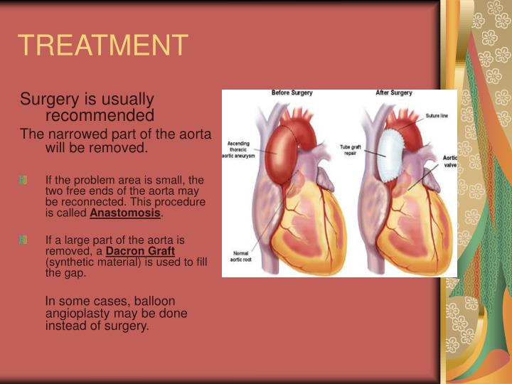 PPT - Coarctation of the Aorta PowerPoint Presentation - ID:472011
