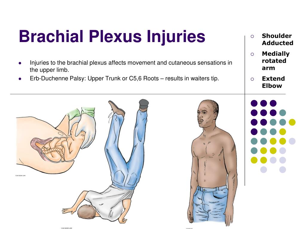 Waiters Tip Brachial Plexus