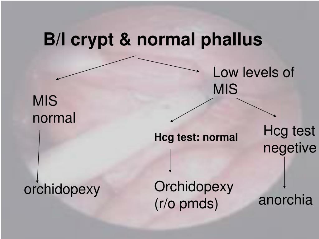 Ppt Cryptorchidism Powerpoint Presentation Free Download Id 474422