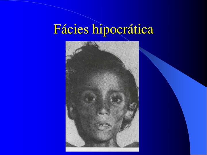 Facies Hippocratica
