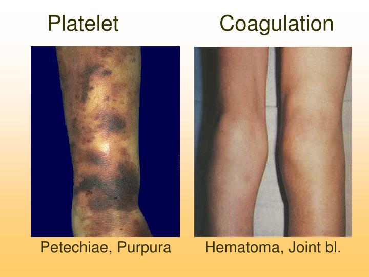 PPT - Bleeding Disorders Vascular and Platelet Disorders PowerPoint ...