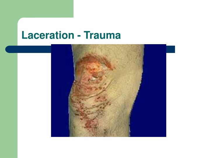 PPT - Bleeding Disorders Vascular and Platelet Disorders PowerPoint ...