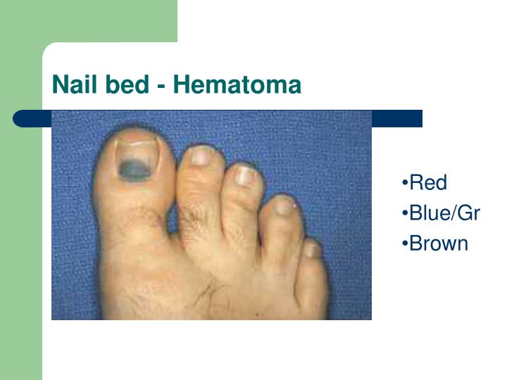 PPT - Bleeding Disorders Vascular and Platelet Disorders PowerPoint ...