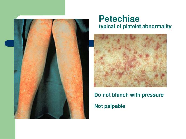 PPT - Bleeding Disorders Vascular and Platelet Disorders PowerPoint ...