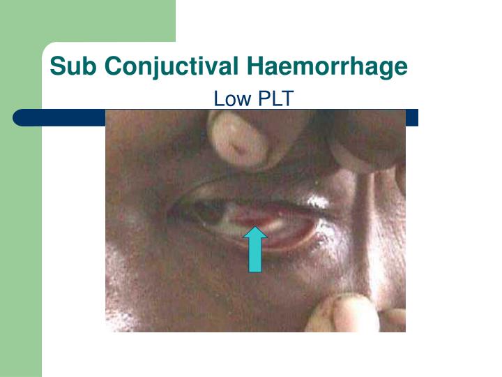 PPT - Bleeding Disorders Vascular and Platelet Disorders PowerPoint ...