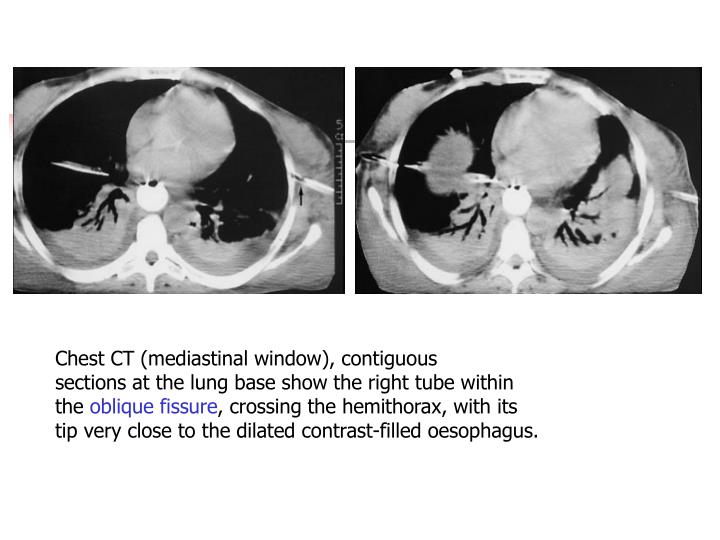 PPT - CT diagnosis of malpositioned chest tube PowerPoint Presentation ...
