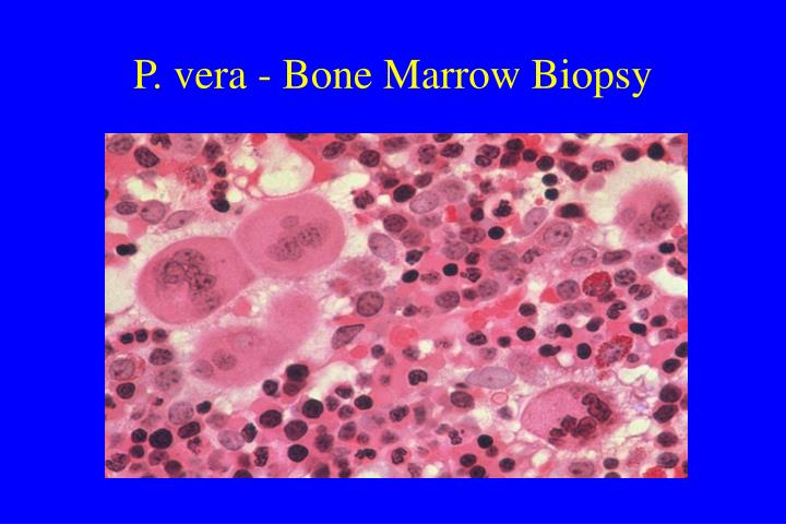 PPT - Polycythemia Vera (lots of red cells - for real) PowerPoint ...
