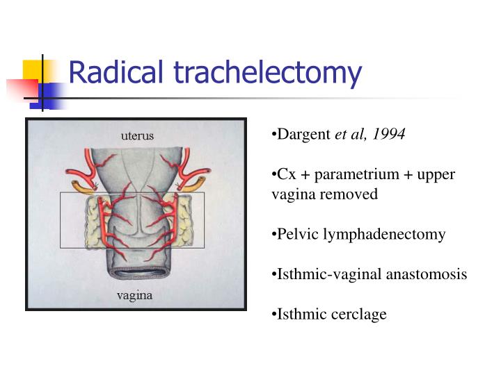 PPT - Cytology after radical trachelectomy for cervical cancer ...
