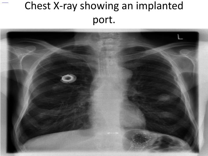 PPT - Port-A- Cath PowerPoint Presentation - ID:480351