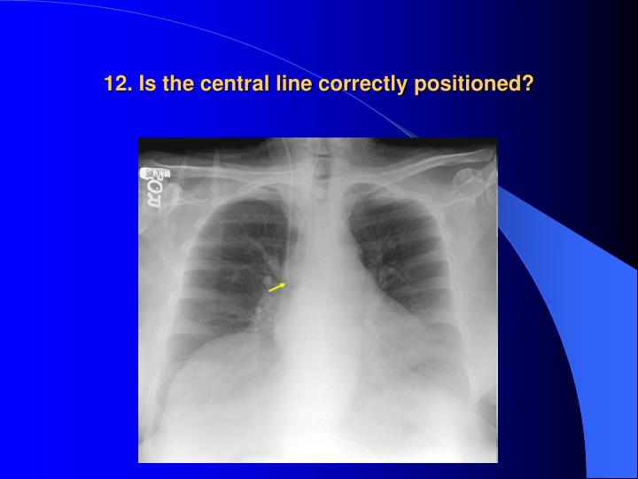 PPT - Chest X-ray Interpretation Quiz PowerPoint Presentation - ID:481118