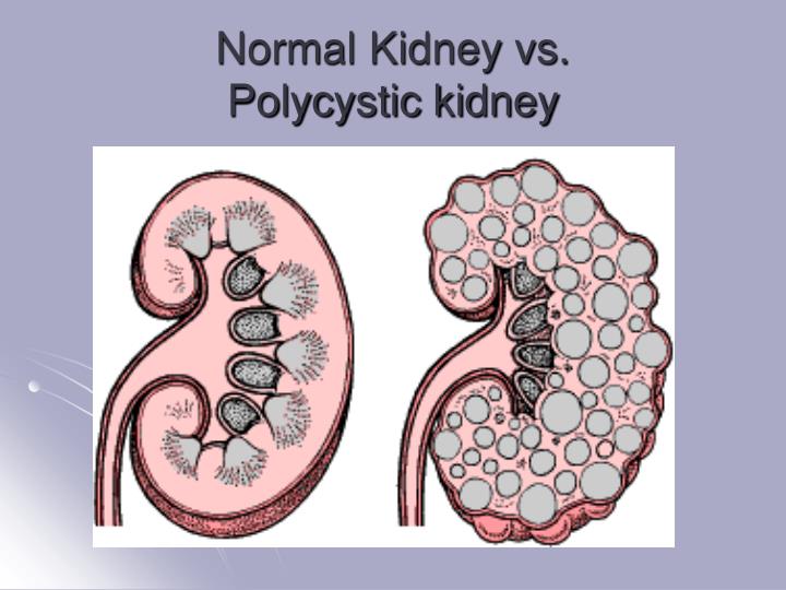 PPT - Genetics and Pathogenesis of Polycystic Kidney Disease PowerPoint ...