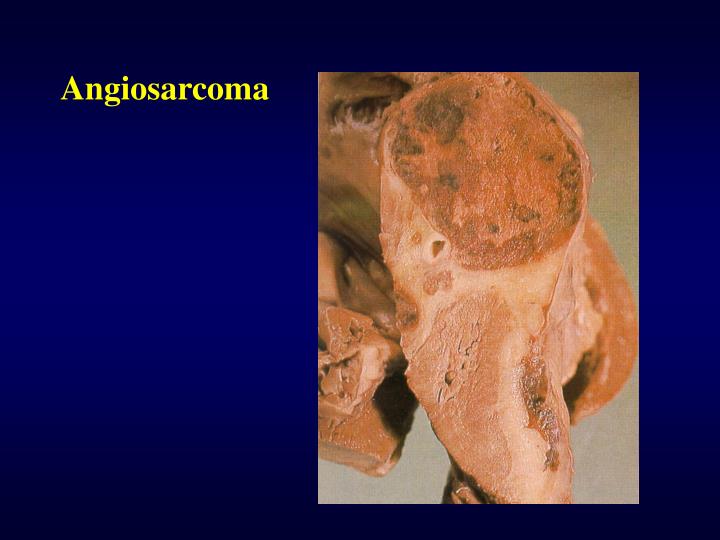 PPT - Cardiac Tumor PowerPoint Presentation - ID:484235