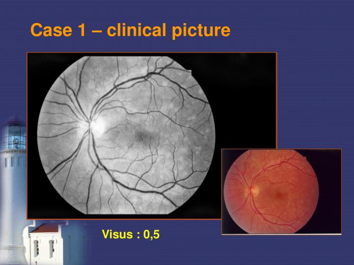PPT - MEWDS Multiple Evanescent White Dot Syndrome PowerPoint ...