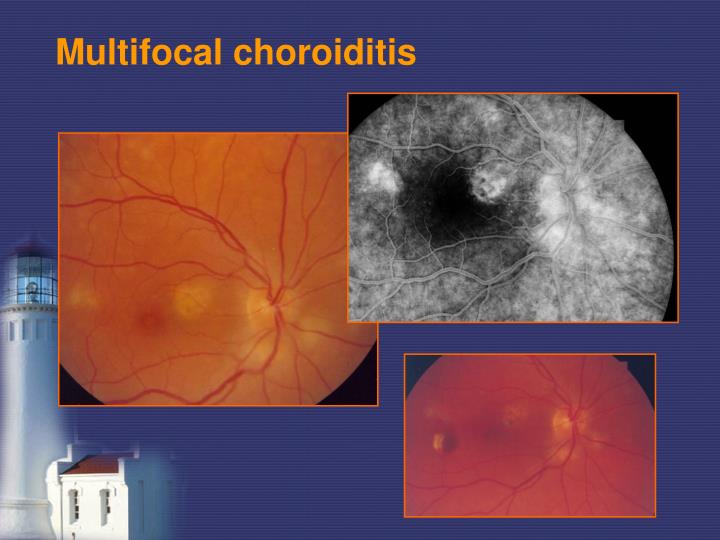 PPT - MEWDS Multiple Evanescent White Dot Syndrome PowerPoint ...