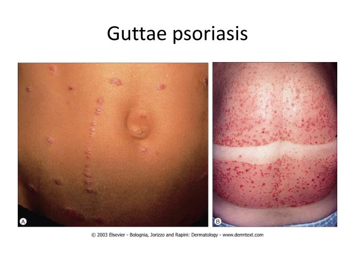 PPT - Psoriasis PowerPoint Presentation - ID:485860