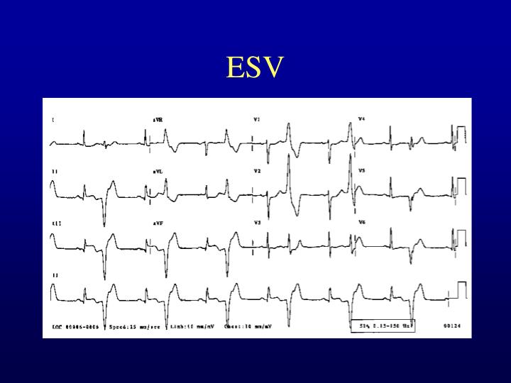 PPT - TROUBLES DU RYTHME PowerPoint Presentation - ID:487296
