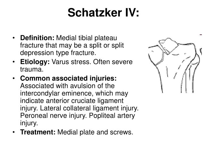 PPT - Fracture of tibia PowerPoint Presentation - ID:489639
