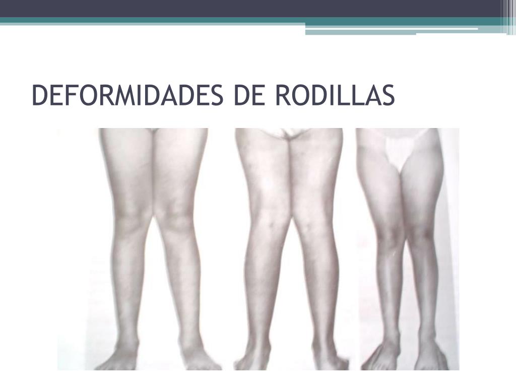 PPT - Ortopedia Pediátrica PowerPoint Presentation, free download - ID ...