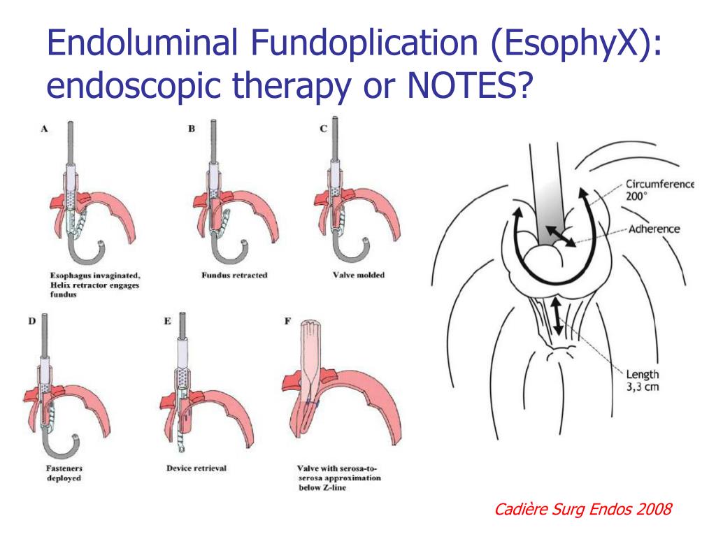 PPT - Traitement du reflux gastro-oesophagien (RGO) : quels sont les ...