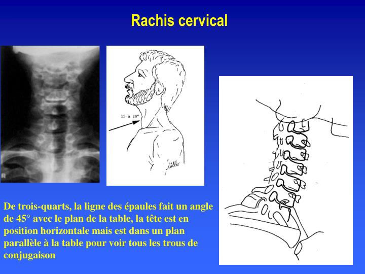 PPT - Radio-anatomie du rachis PowerPoint Presentation - ID:495067