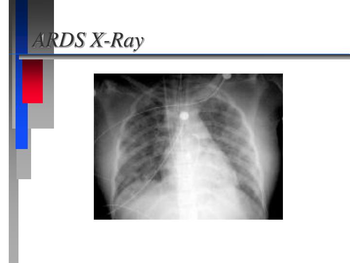 PPT - RESPIRATORY FAILURE and ARDS PowerPoint Presentation - ID:497707