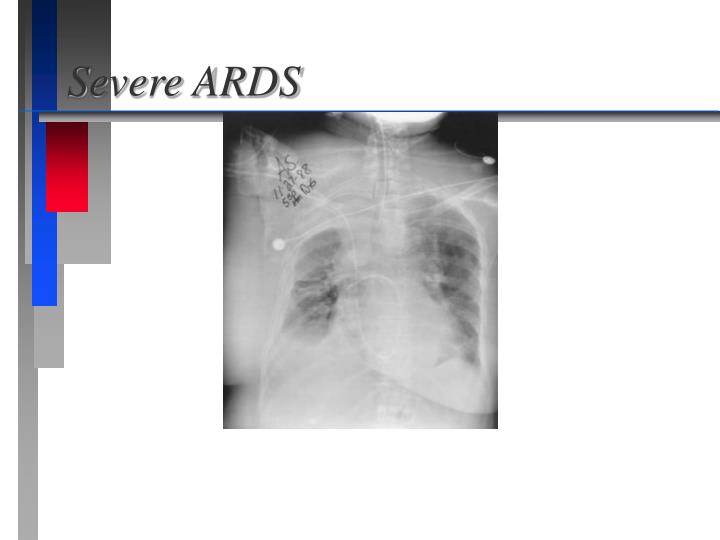 PPT - RESPIRATORY FAILURE and ARDS PowerPoint Presentation - ID:497707