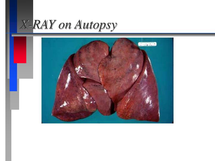 PPT - RESPIRATORY FAILURE and ARDS PowerPoint Presentation - ID:497707