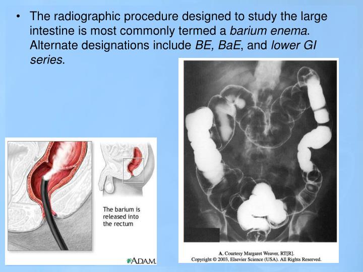 PPT - Lower GI PowerPoint Presentation - ID:499011