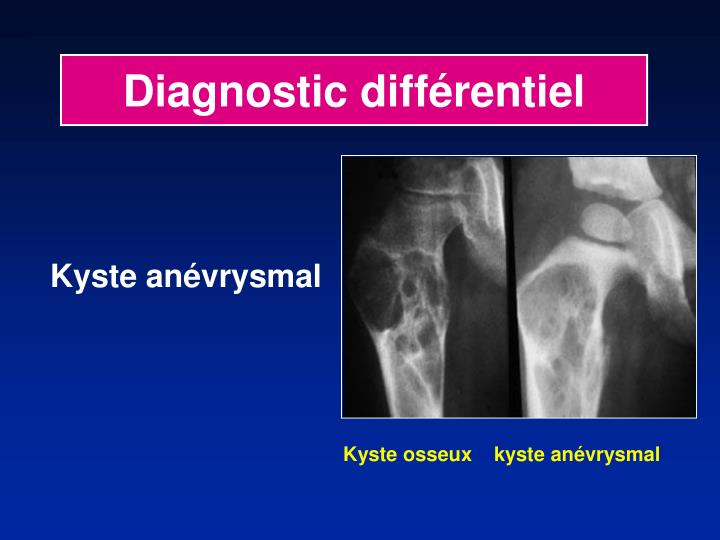 PPT - KYSTE OSSEUX (kyste solitaire) PowerPoint Presentation - ID:507080