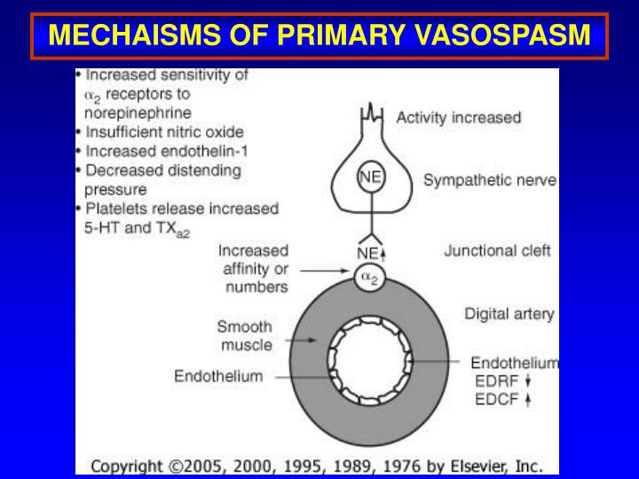 PPT - 93 RAYNAUD’S SYNDROME: VASOSPASTIC AND OCCLUSIVE ARTERIAL DISEASE ...