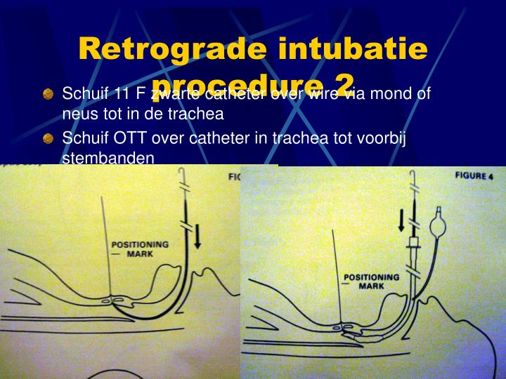 PPT - Intubatie en moeilijke intubatie PowerPoint Presentation - ID:509358