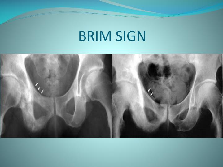 PPT - SIGNS IN RADIOLOGY PowerPoint Presentation - ID:510632