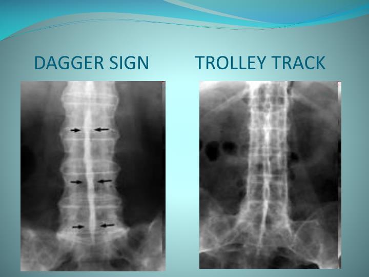 PPT - SIGNS IN RADIOLOGY PowerPoint Presentation - ID:510632