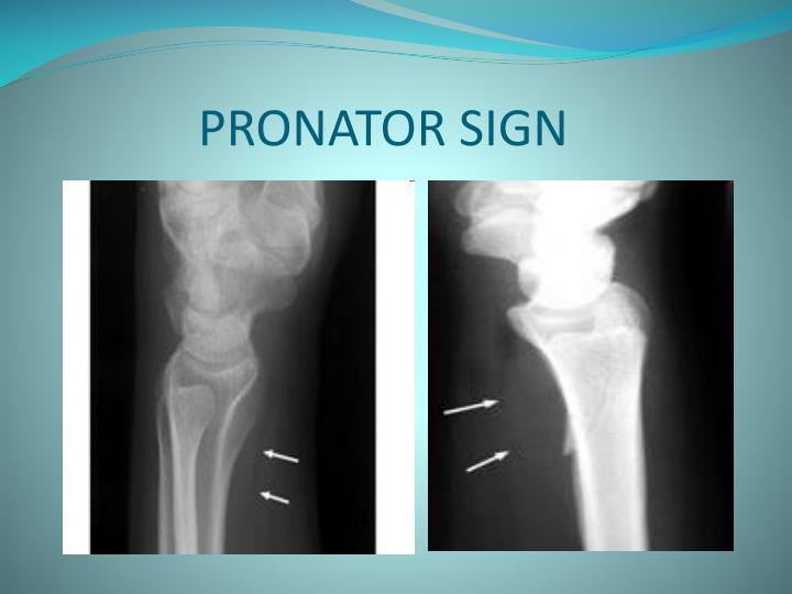 PPT - SIGNS IN RADIOLOGY PowerPoint Presentation - ID:510632
