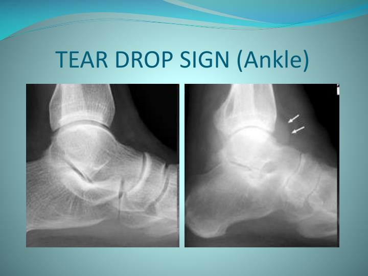 PPT - SIGNS IN RADIOLOGY PowerPoint Presentation - ID:510632