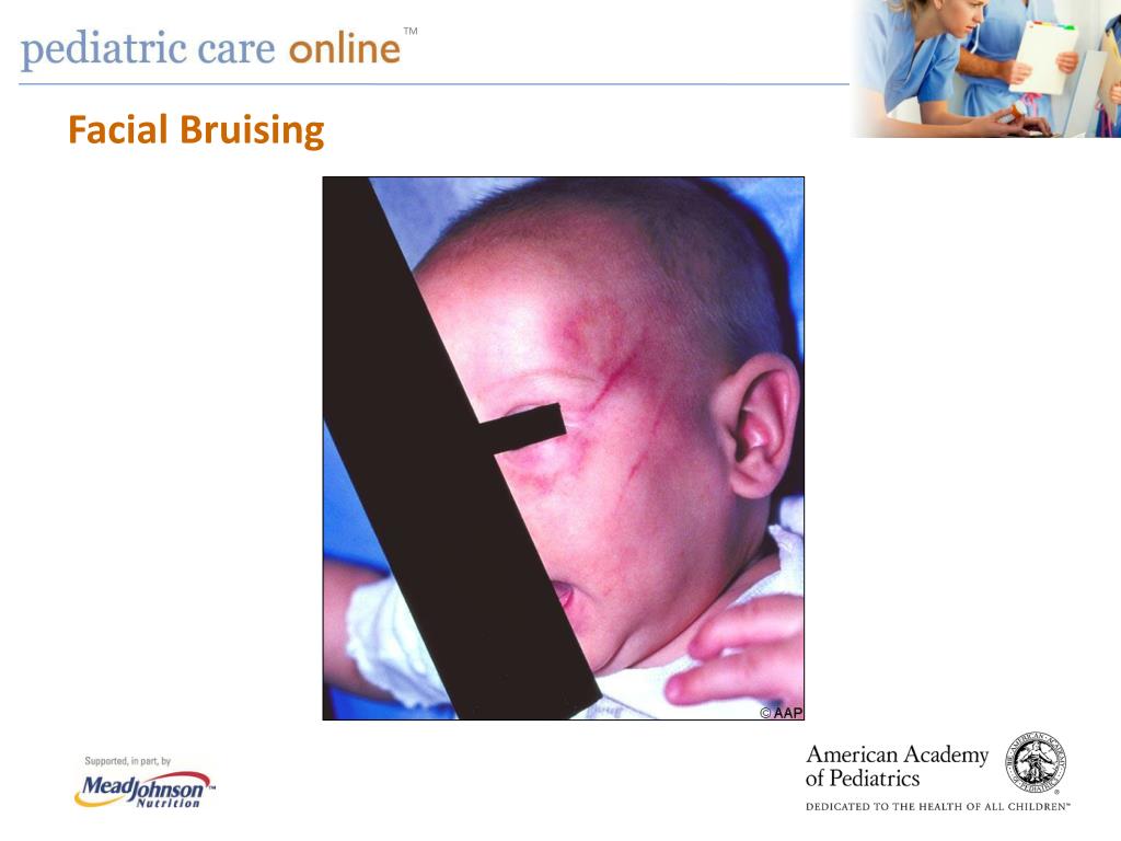 PPT - Child Abuse for the Primary Care Physician Cindy W. Christian, MD ...