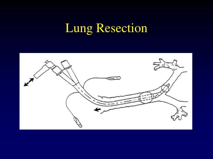 PPT - Common Thoracic Procedures PowerPoint Presentation - ID:520658