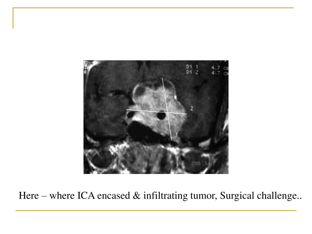 PPT - Accuracy of intra-operative rapid diagnosis by Squash smear in ...
