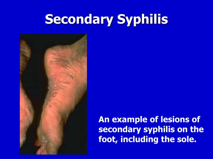 PPT - Syphilis – Clinical Aspects of Secondary Syphilis PowerPoint ...