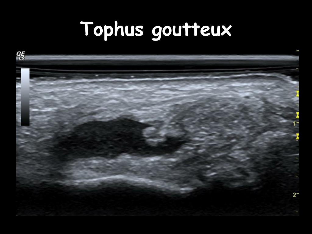 PPT - Le rôle de l’échographie du genou dans les arthropathies ...