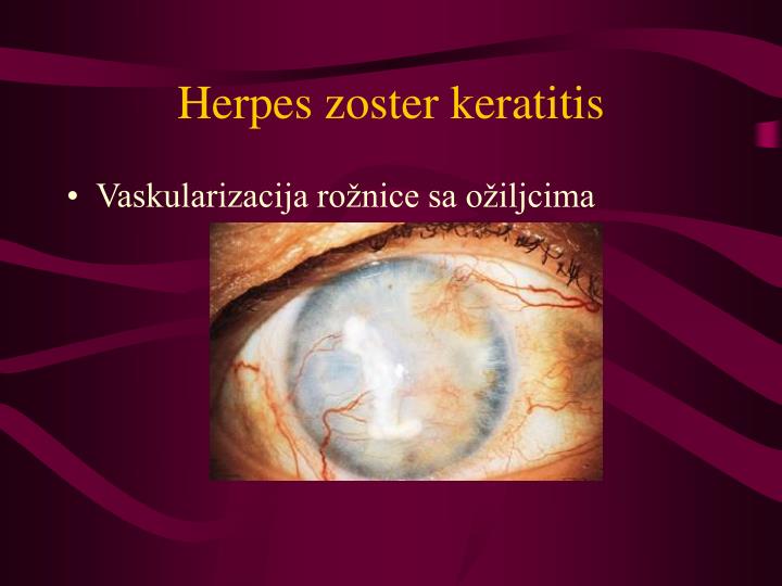 PPT - ROŽNICA- CORNEA PowerPoint Presentation - ID:534034