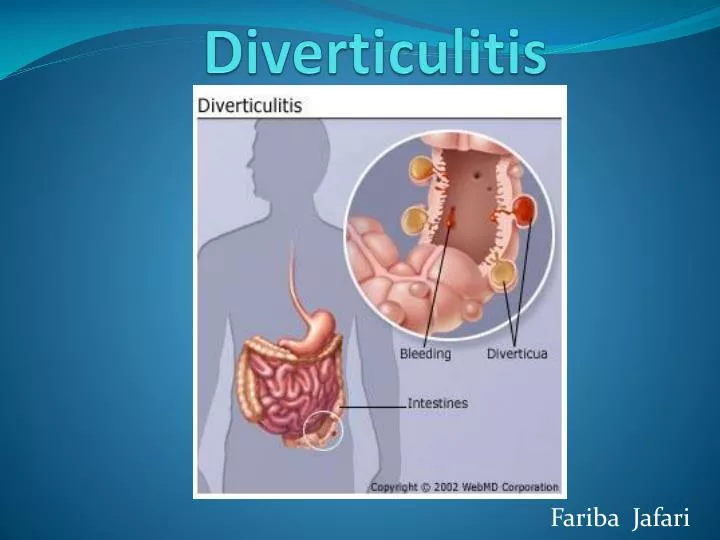 PPT - Diverticulitis PowerPoint Presentation, free download - ID:540587