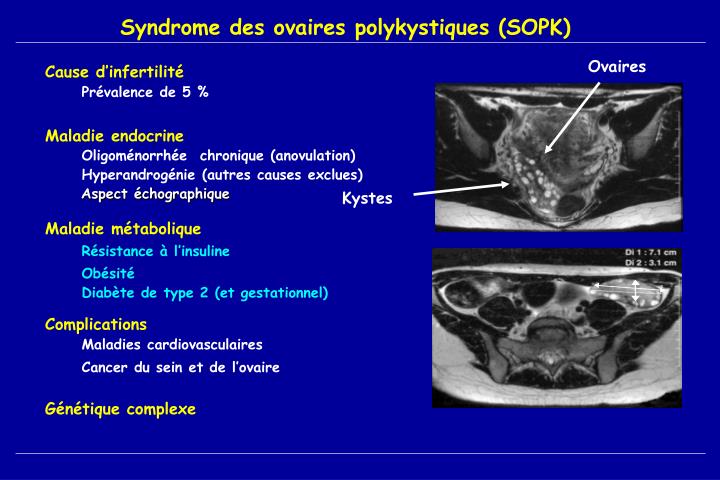 PPT - SYNDROME DES OVAIRES PowerPoint Presentation - ID:542038