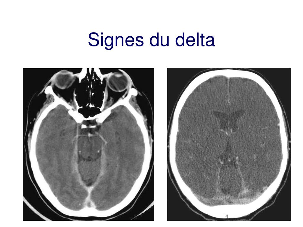 PPT - THROMBOSES VEINEUSES CEREBRALES PowerPoint Presentation, free ...